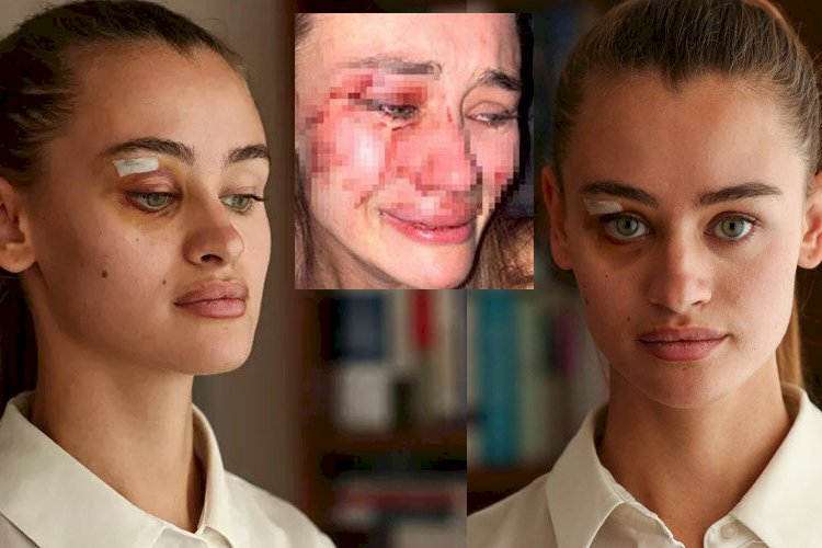 Ukraynalı model Daria Kyryliuk darp iddiasıyla ilgili ilk kez konuştu ...